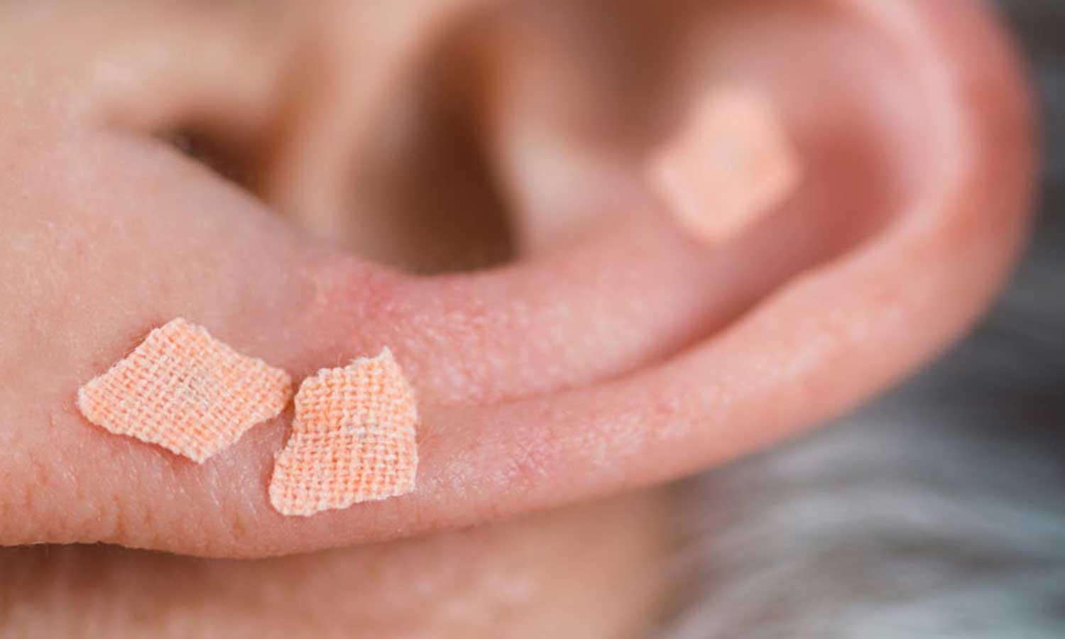 Curso de Auriculoterapia - VIP Learning